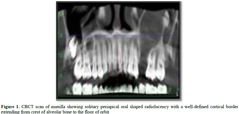 SCITECH - A Giant Radicular Cyst Involving the Left Maxillary Sinus ...