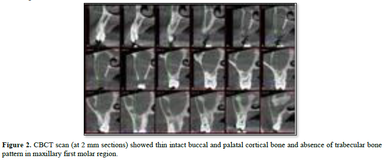 SCITECH - A Giant Radicular Cyst Involving the Left Maxillary Sinus ...