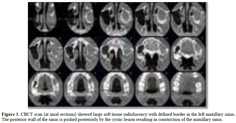 SCITECH - A Giant Radicular Cyst Involving the Left Maxillary Sinus ...